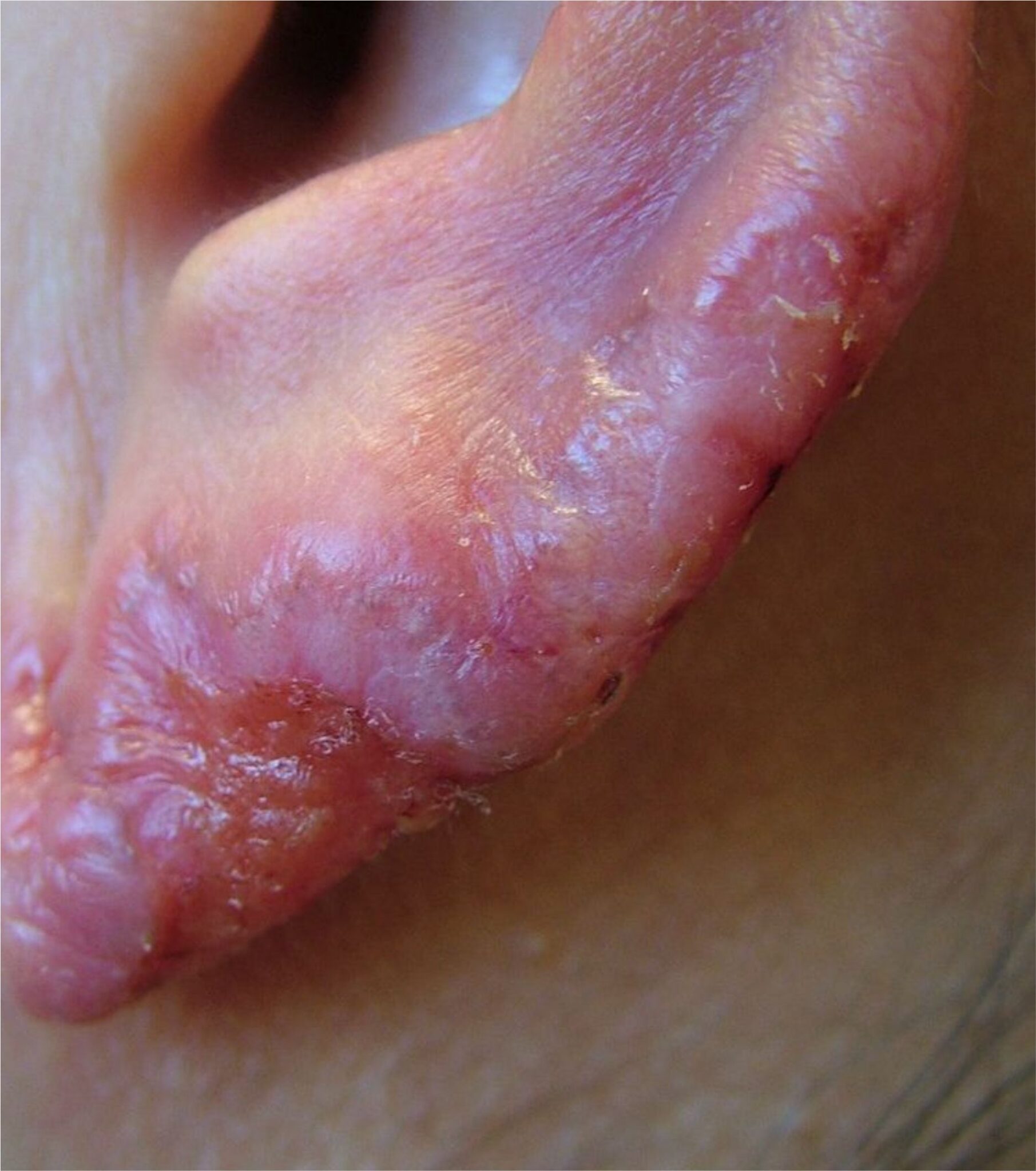 SKIN TUBERCULOSIS - Best Skin Clinic in Gurgaon