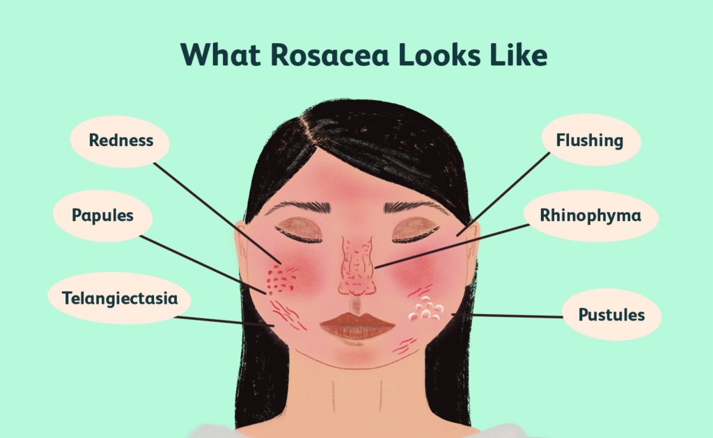 Rosacea: Types, Causes, Symptoms, Diagnosis, Risk Factors: Prettyskin ...
